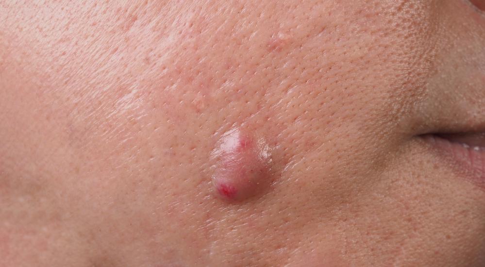 Wart Removal NYC Dermatologist Removing Warts in NYC Wart Treatments