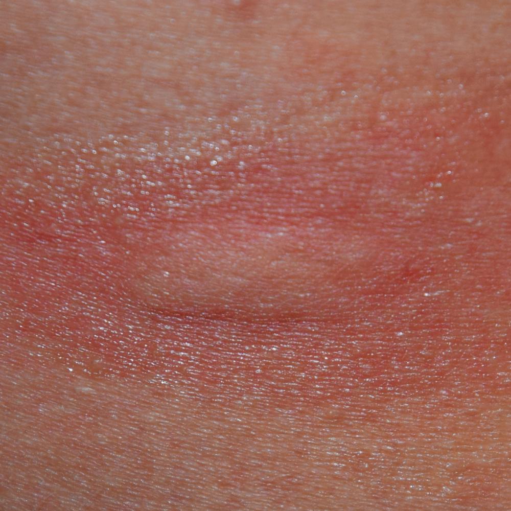 Hidradenitis Suppurativa Diagnosis Criteria | Managing Hidradenitis ...